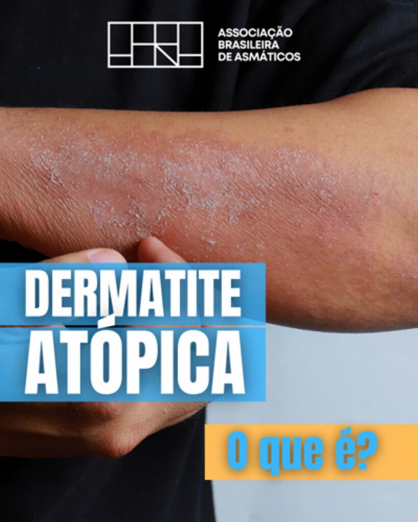 O que é Dermatite Atópica? - ABRA